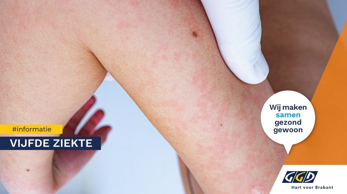 Vijfde ziekte - GGD Hart voor Brabant